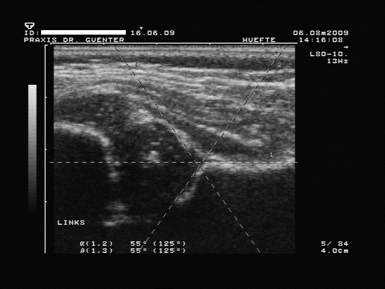 Sonographie bzw. Ultraschall-Untersuchung der Säuglingshüfte ...
