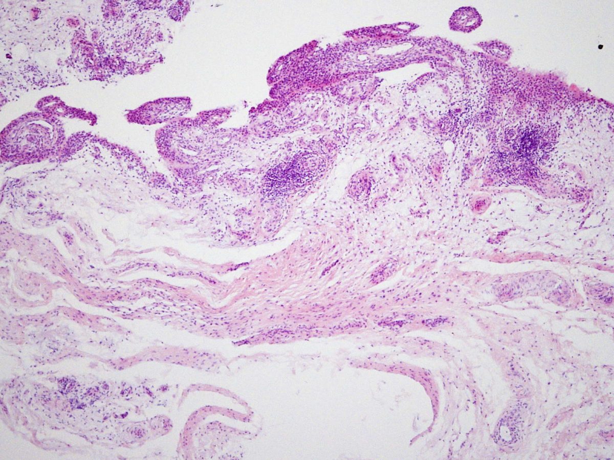 reaktive Synovialitis und rheumatoide Arthritis - Biologische ...