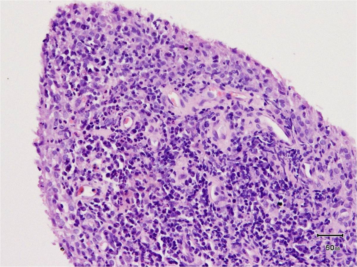 reaktive Synovialitis und rheumatoide Arthritis - Biologische ...